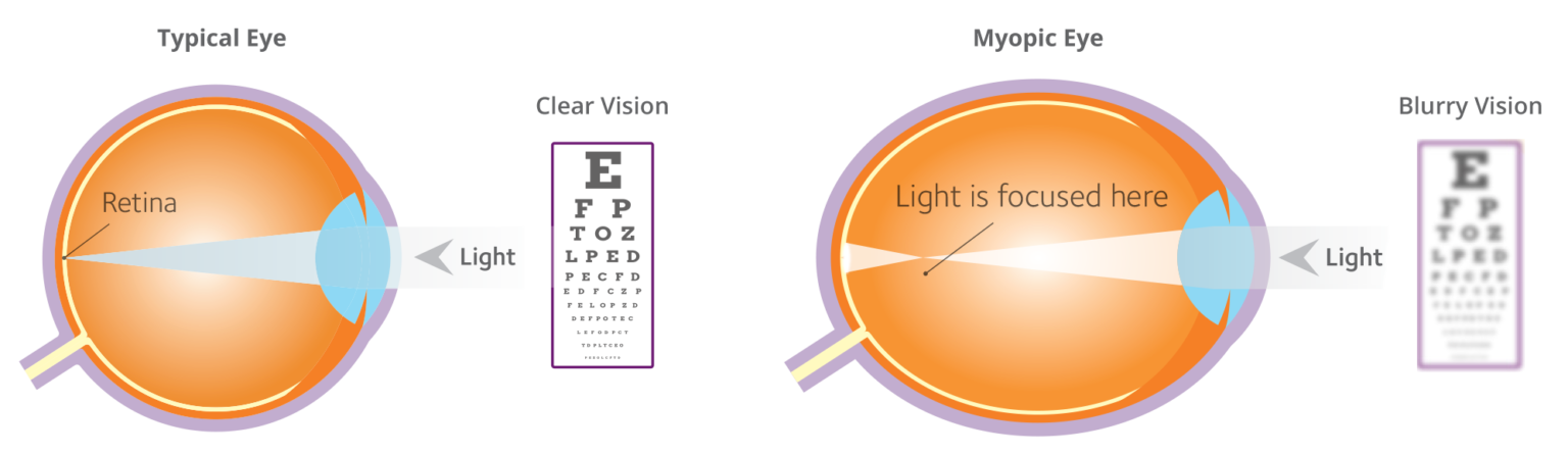 Myopia Control | St. Lawrence Eye Care